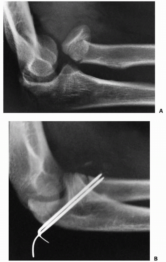 Proximal Radial Head Fracture Splint Booltelecom