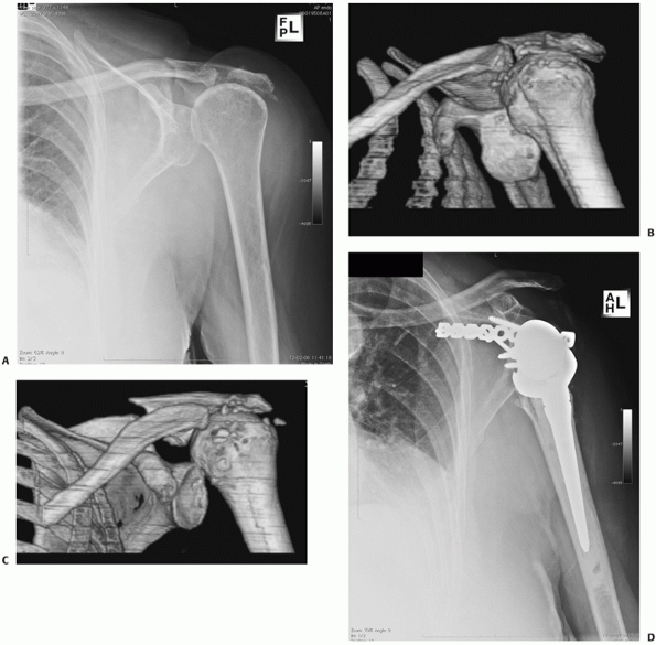 Scapula Fracture Fixation At Ruth Eckel Blog